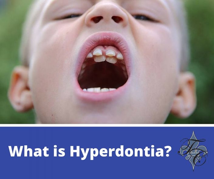 What is hyperdontia - Dr Chauvin