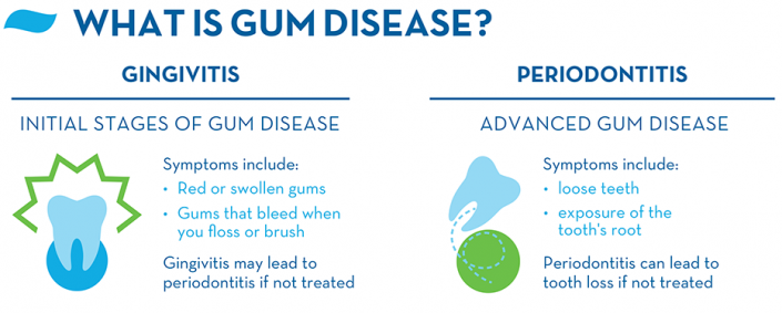 what-is-gingivitis-and-periodontitis - Dr Chauvin